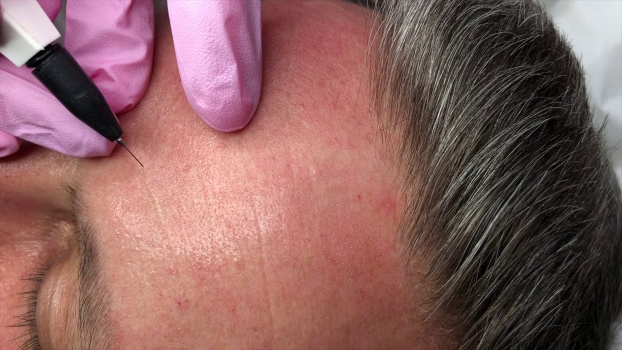 Sebaceous Hyperplasia Removal Appearances Aesthetics YouTube sebaceous-hyperplasia-removal-appearances-aesthetics-youtube