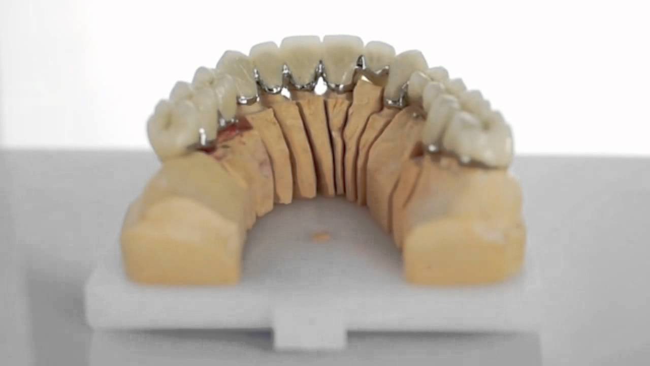 K Dental Lab PFM 1 - YouTube