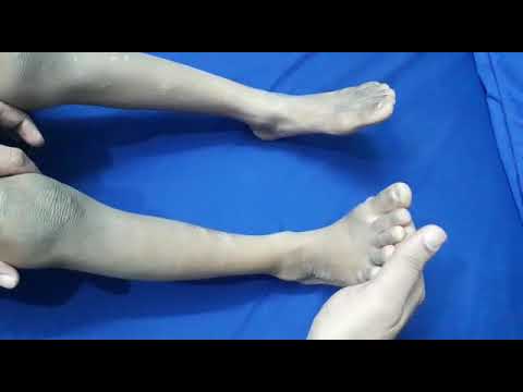 #AnkleClonusTest!!!! #orthopaedics - YouTube