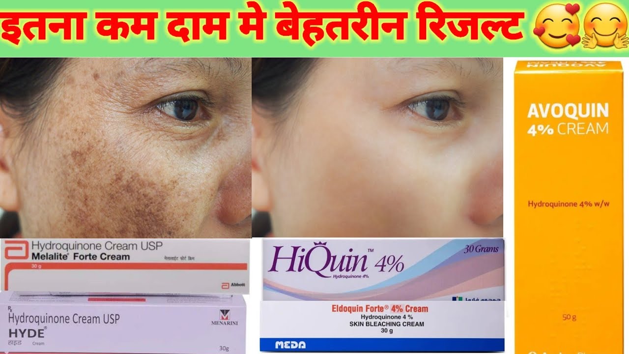Hydroquinone 4% Cream/Avoquin/Hiquin/Eldroquin/Melalite/Hyde - YouTube