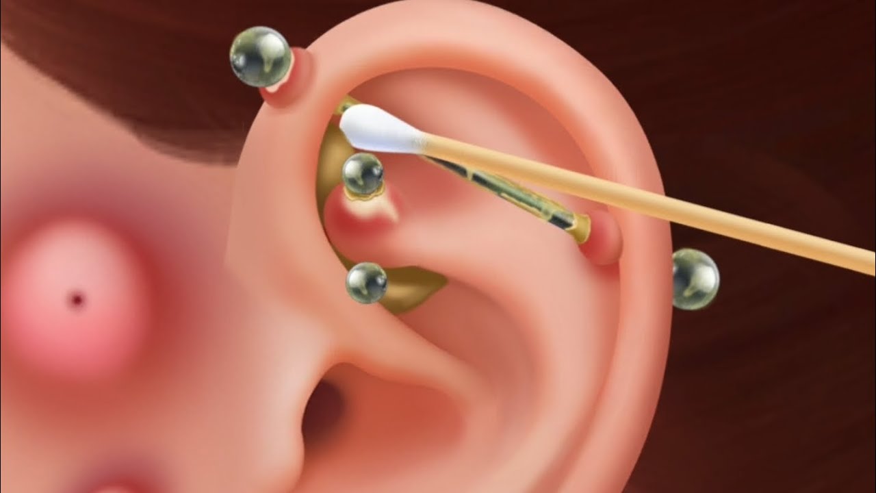 ASMR infected removal! Pulling pus out of the ear and popping pimples ...