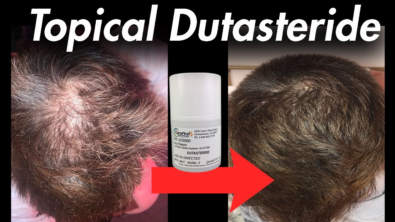 Topical Dutasteride WILL Work: Clinical Trial Insights (0.15% - 0.50% ...