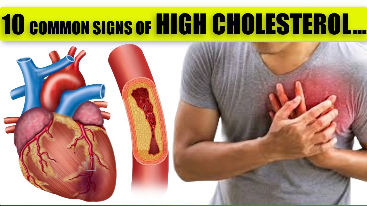 10 Common Signs of High CHOLESTEROL You SHOULD NOT Ignore | Amazing ...