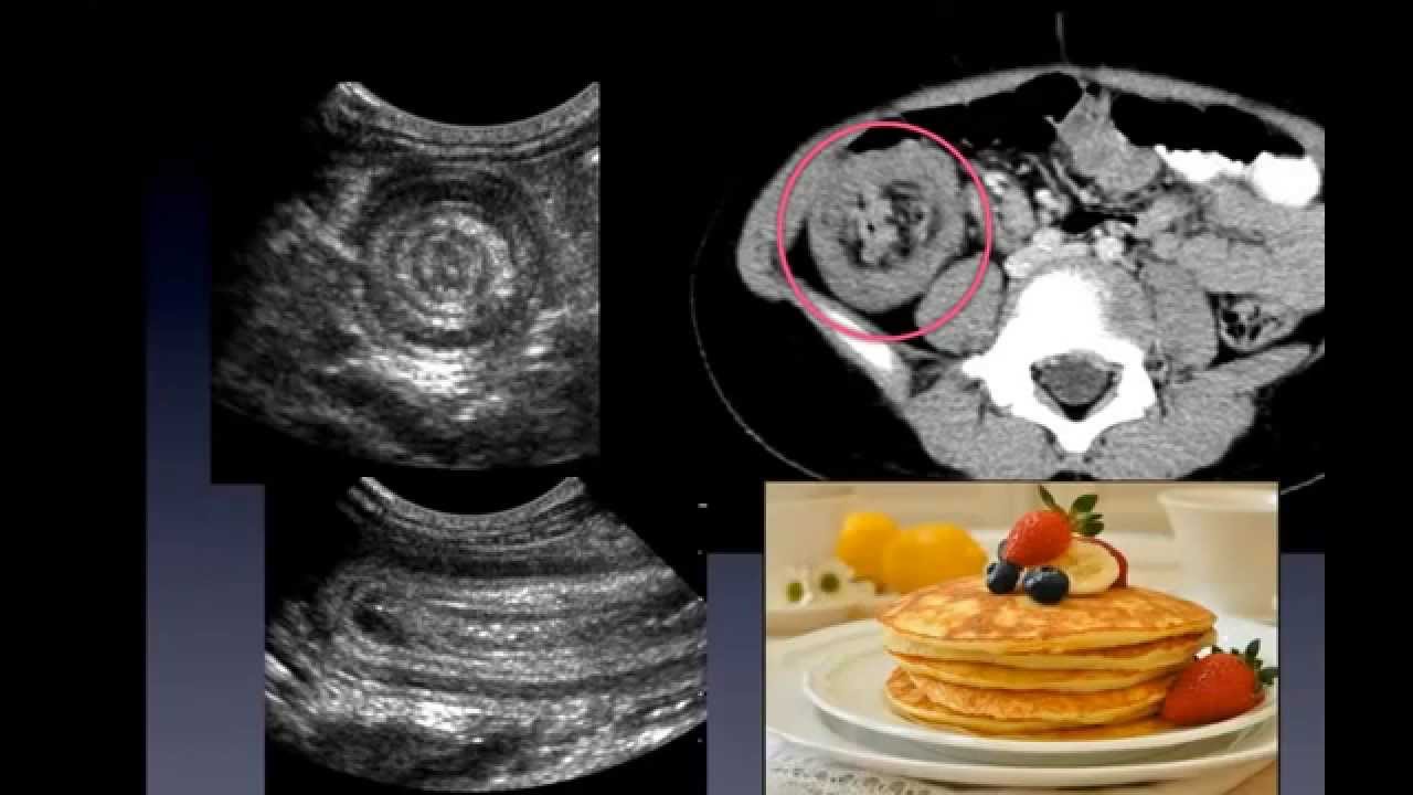 Ultrasound Podcast - Intussusception part 2 with @pemedpocast. #foamed ...
