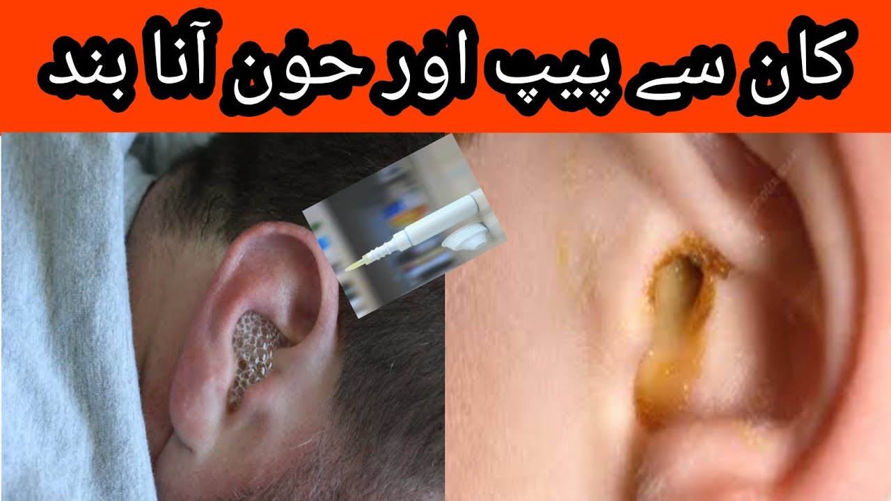 Xecomb ear drop for pus | inside ear infection#earinfection - YouTube