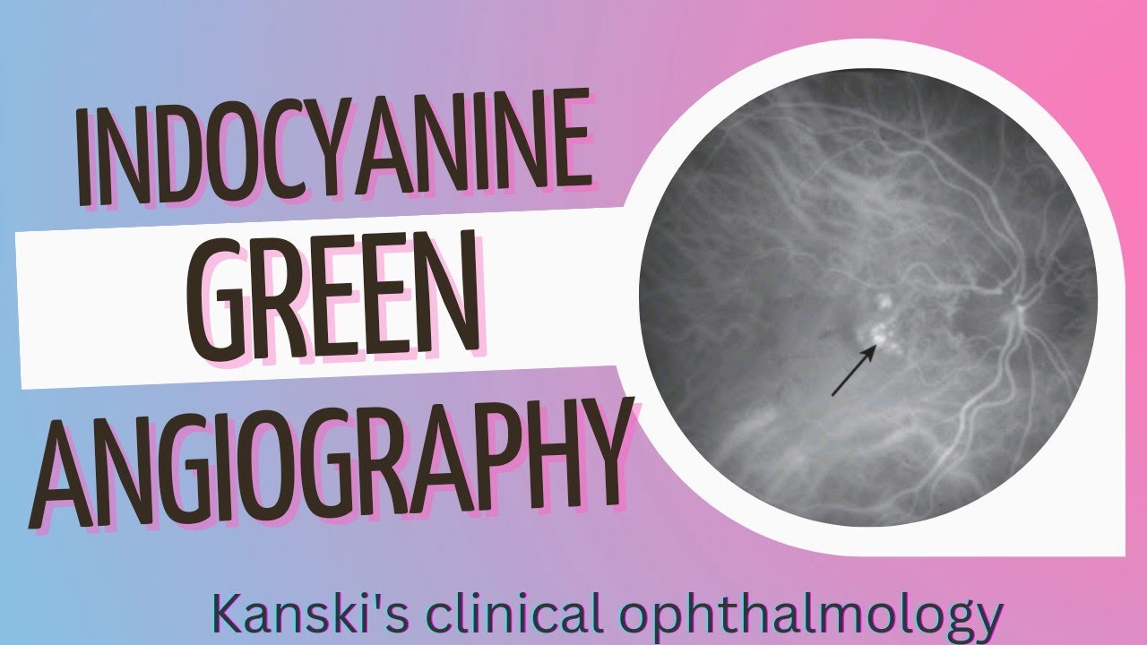 Indocyanine green angiography (ICGA)-Kanski clinical ophthalmology # ...