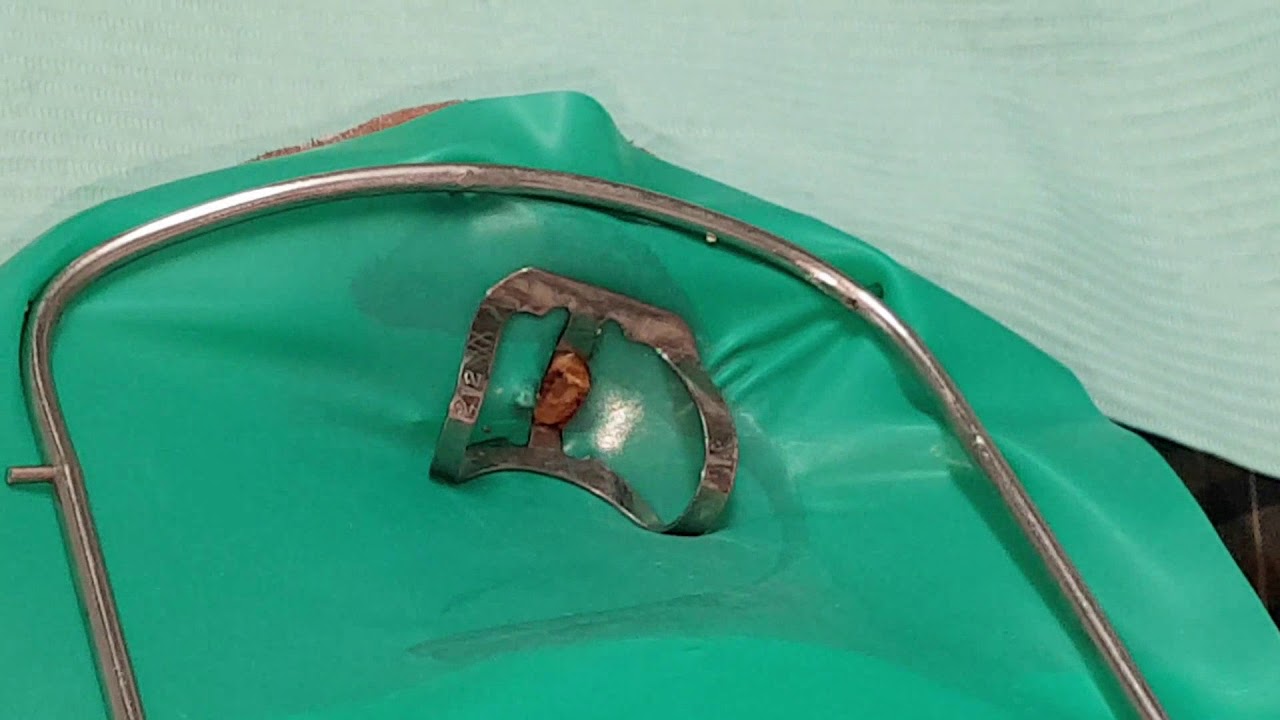 Aislamiento Absoluto de remanente radicular - YouTube