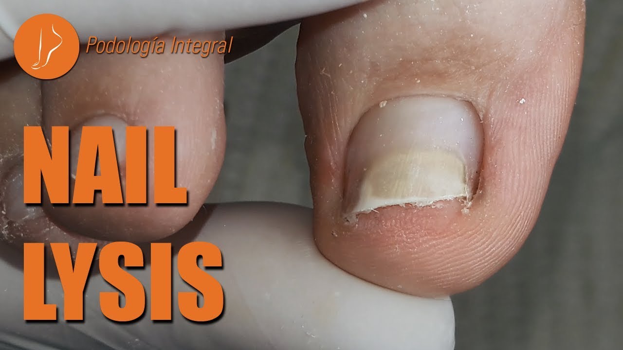 Nail lysis | 1st video #podologiaintegral - YouTube