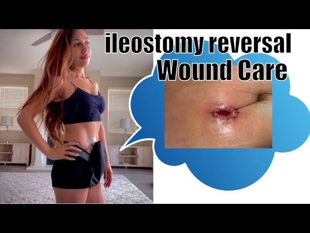 Ileostomy Reversal