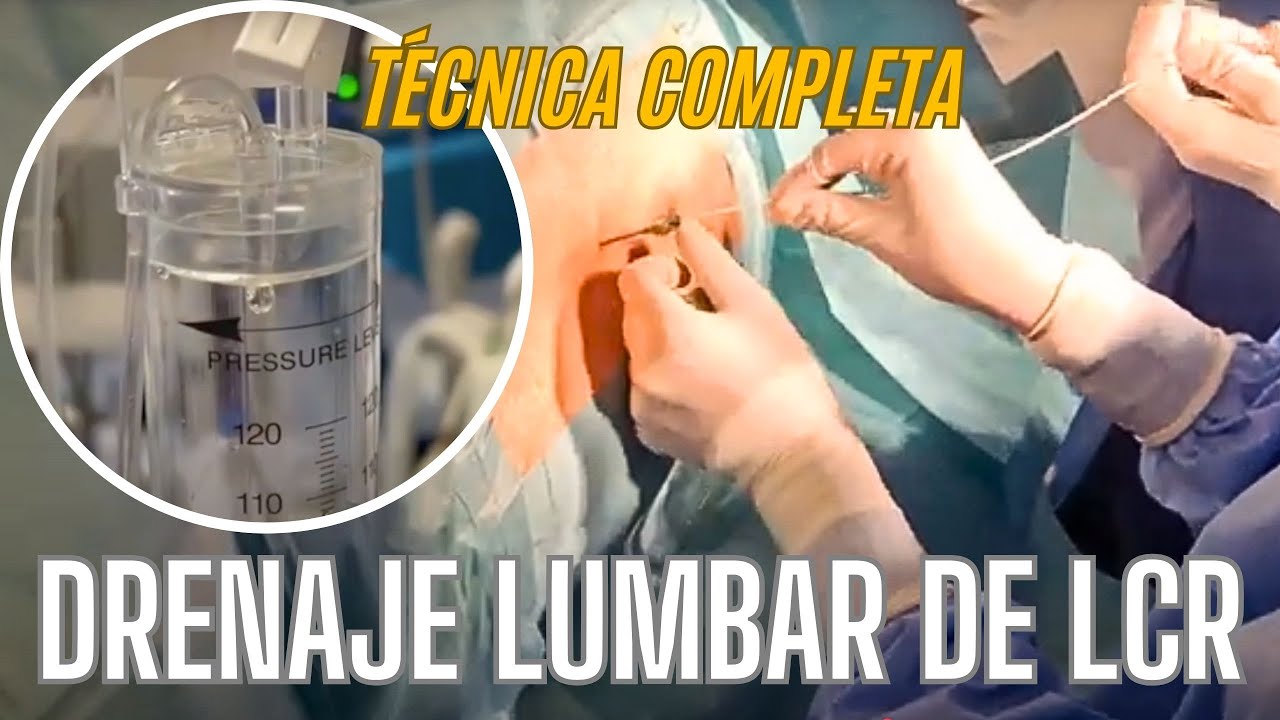 Cómo Insertar un DRENAJE LUMBAR DE LCR como PROTECCION MEDULAR en ...
