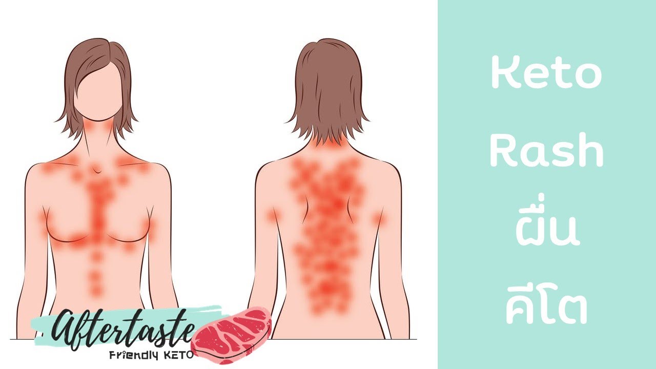 กินคีโตแล้วผื่นขึ้น ทำยังไง? (Keto rash) │ Aftertaste FriendlyKETO ...