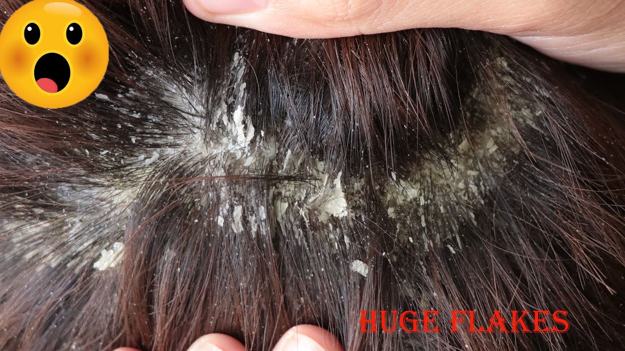 BIG DANDRUFF FLAKES Scalp scratching and picking Satisfying Dandruff ...