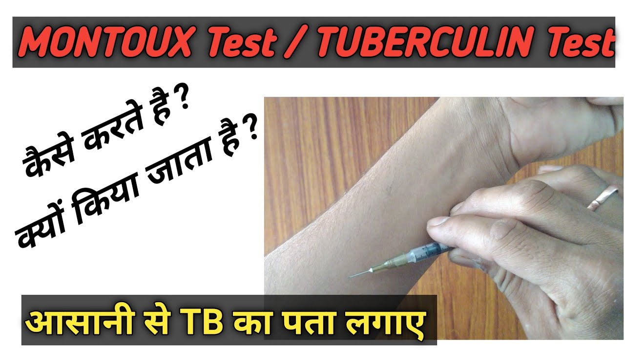 How to perform #Tuberculin #Montoux test || TB की जांच कैसे करे ? - YouTube