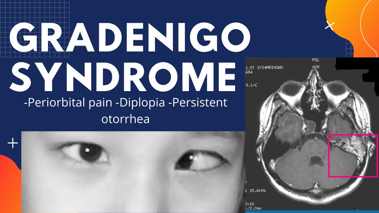 Gradenigo Syndrome - YouTube