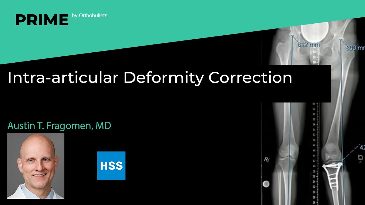 Intra-articular Deformity Correction - Austin T. Fragomen, MD - YouTube