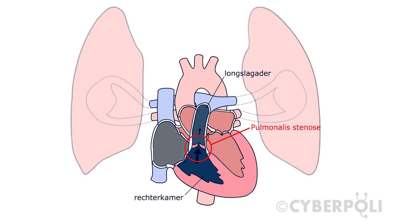 Pulmonalisstenose - YouTube