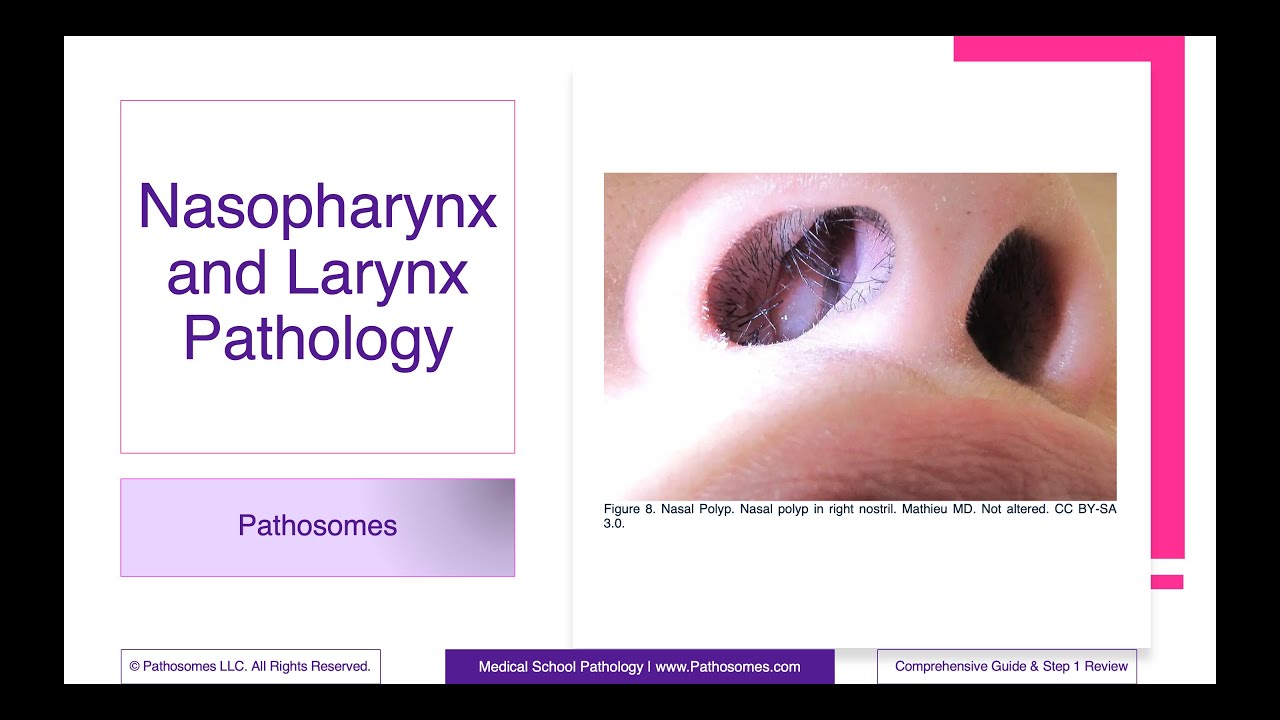 Nasopharynx and Larynx Pathology | Comprehensive Guide & Step 1 Review ...