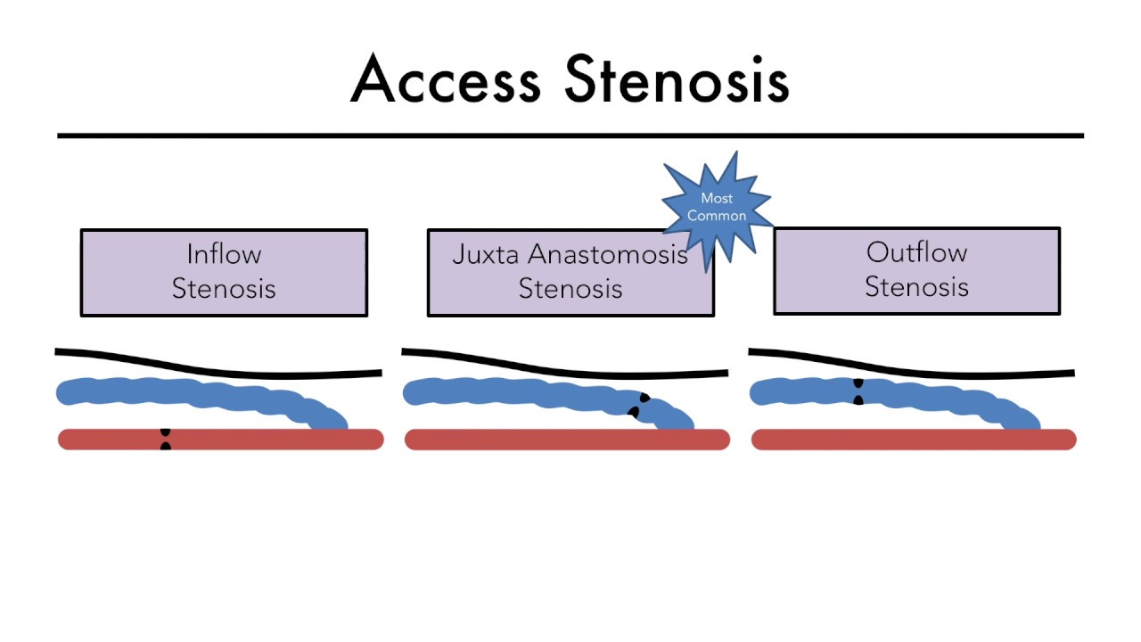 Hemodialysis Access 101 04 - Part 1: Access Stenosis - YouTube