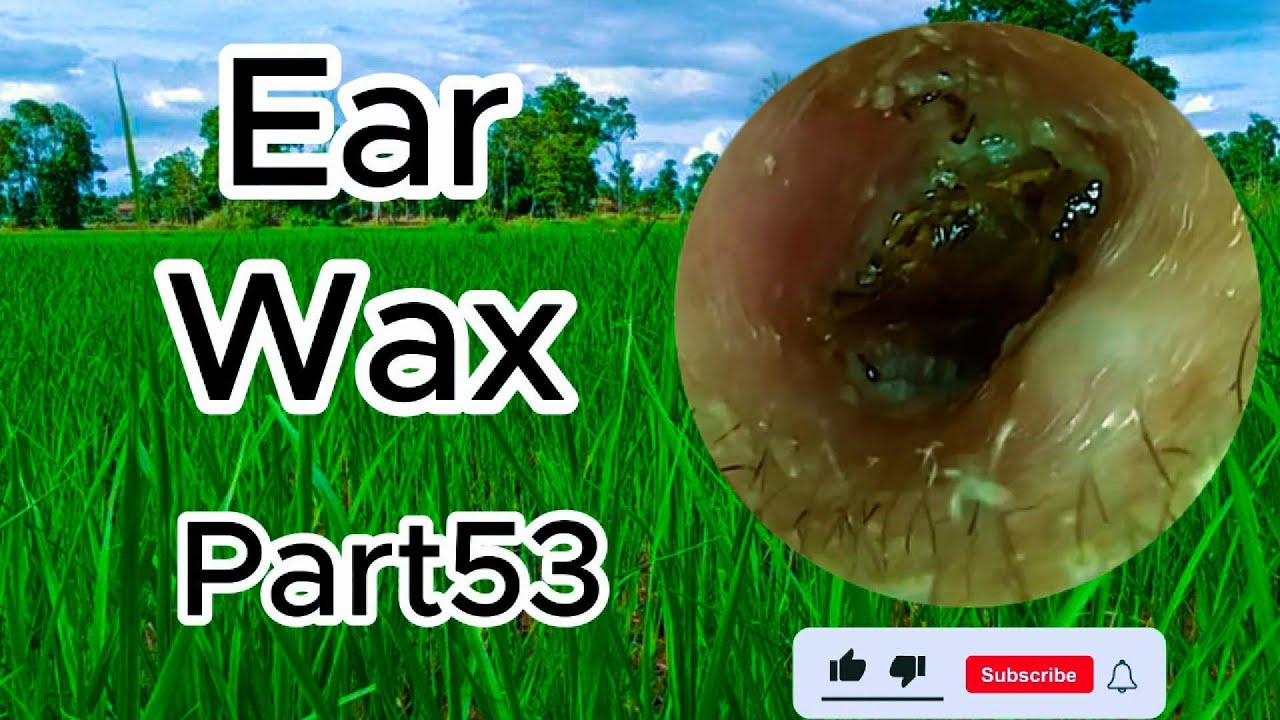 ASMR Ear Wax Removal Compilation - YouTube