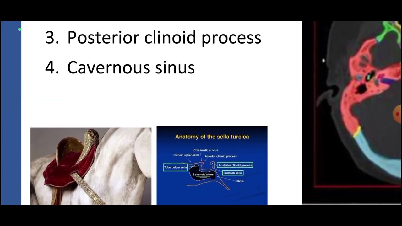 L6 Radiology ( Head and Neck) RLM 41 - YouTube