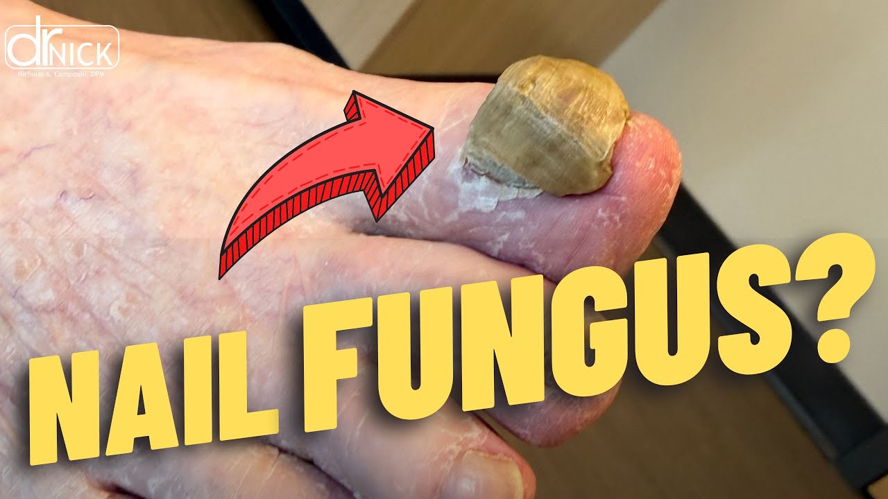 Cutting a Giant Thick Toenail (Satisfying Removal) - YouTube