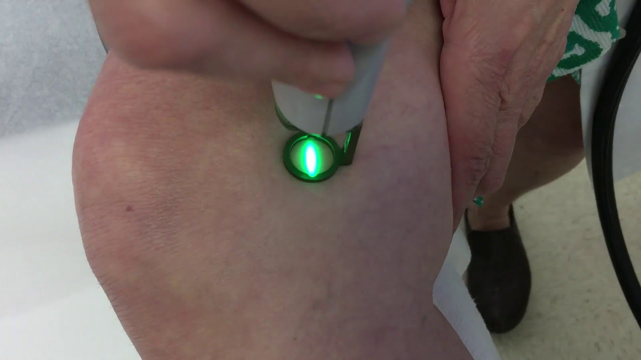 VBeam for Spider Veins on Legs - YouTube