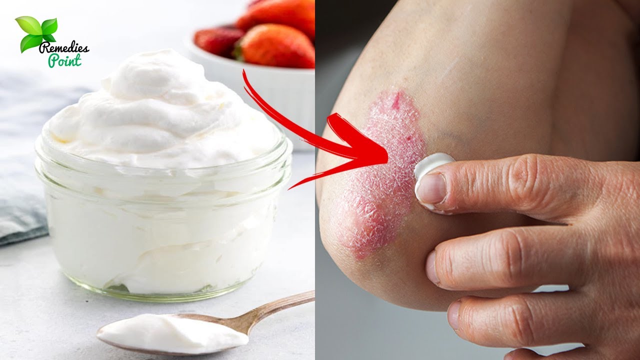 Top 5 Home Remedies For Scaly Elbows And Knees How To Get Rid Of Dry top-5-home-remedies-for-scaly-elbows-and-knees-how-to-get-rid-of-dry