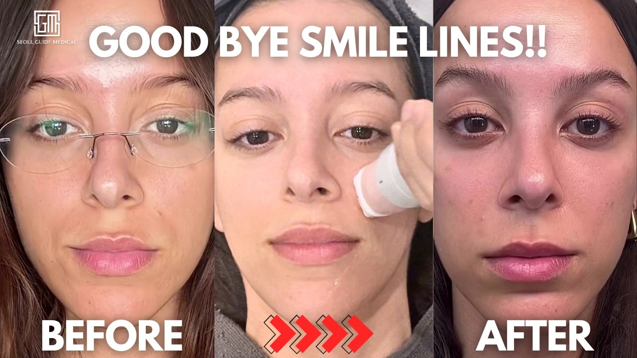 I Fixed My Smile Lines Without Fillers | Volnewmer & Ultracol for Smile Lines - YouTube