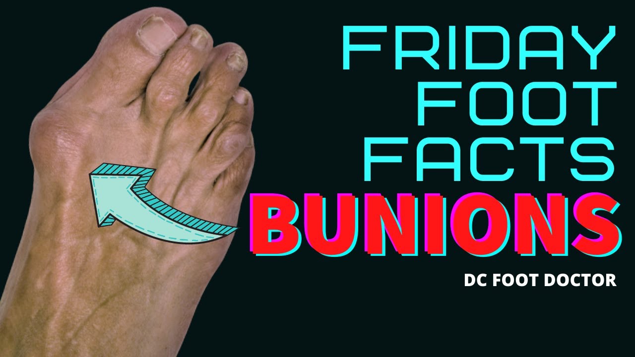 Friday Foot Facts/FAQs Episode #1: Bunions - YouTube