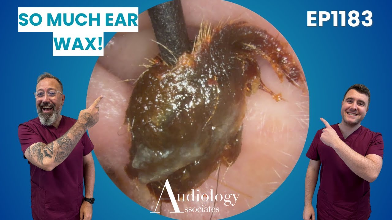 Deep, Dark, & Chunky! Satisfying Ear Wax Extraction - EP1183 - YouTube