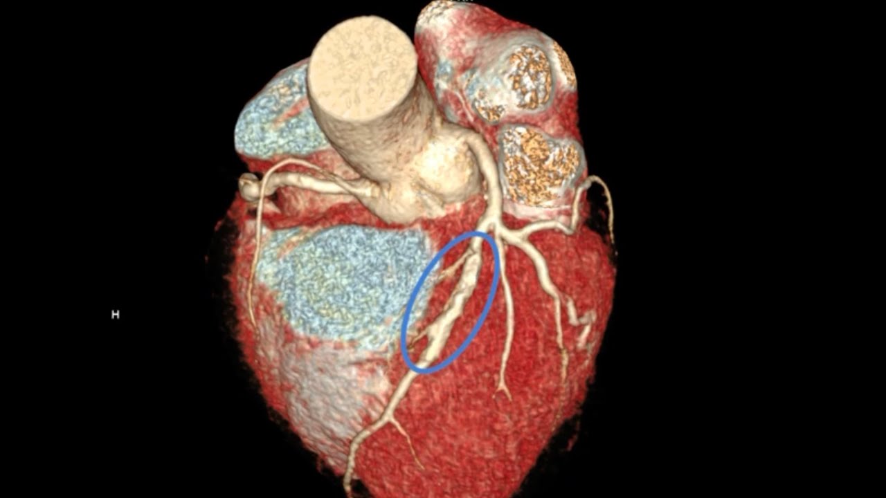 How to perform CT scan in patients with STENTs - YouTube