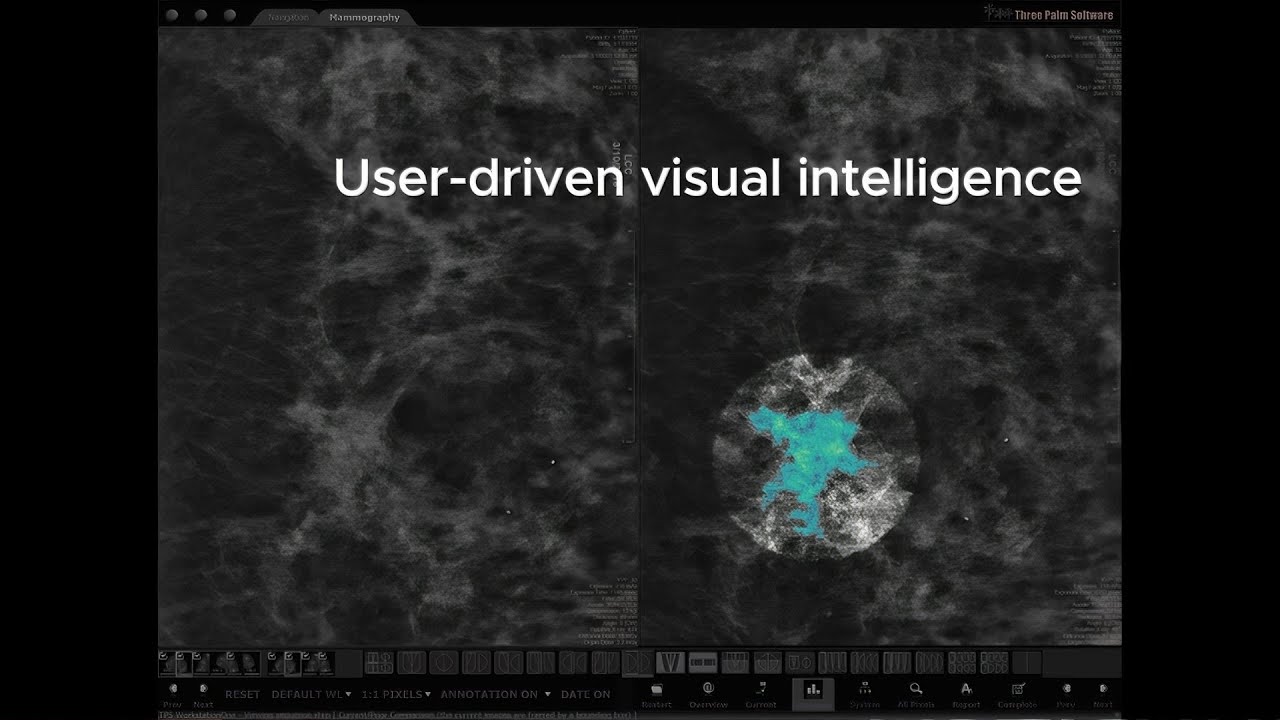 Introducing DL Precise™: Visual Intelligence in Breast Imaging - YouTube