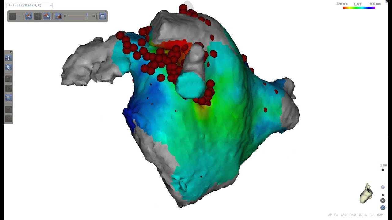 Focal atrial tachycardia originating at coumadin ridge of the left ...