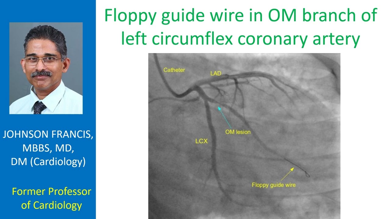 Obtuse Marginal Coronary Artery Anatomy