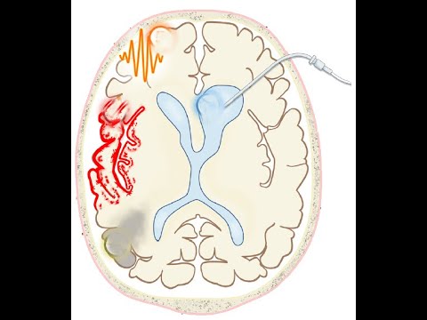 Milrinone in Vasospasm SAH (Subarachnoid Hemorrhage)_Dr Pradeep ...