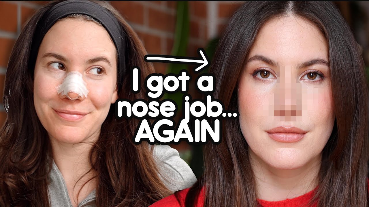 I Got (Another) Nose Job 👀 | My Revision Rhinoplasty Journey & Recovery ...