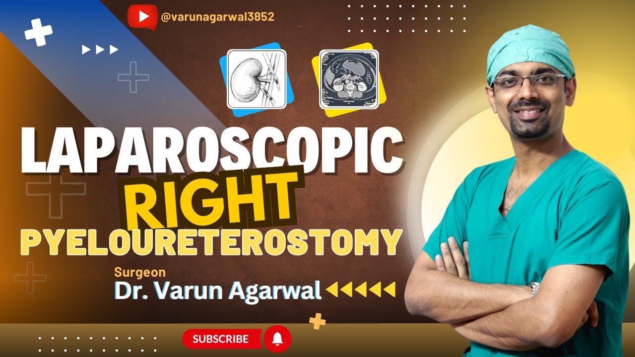 Laparoscopic Right PyeloUreterostomy - YouTube