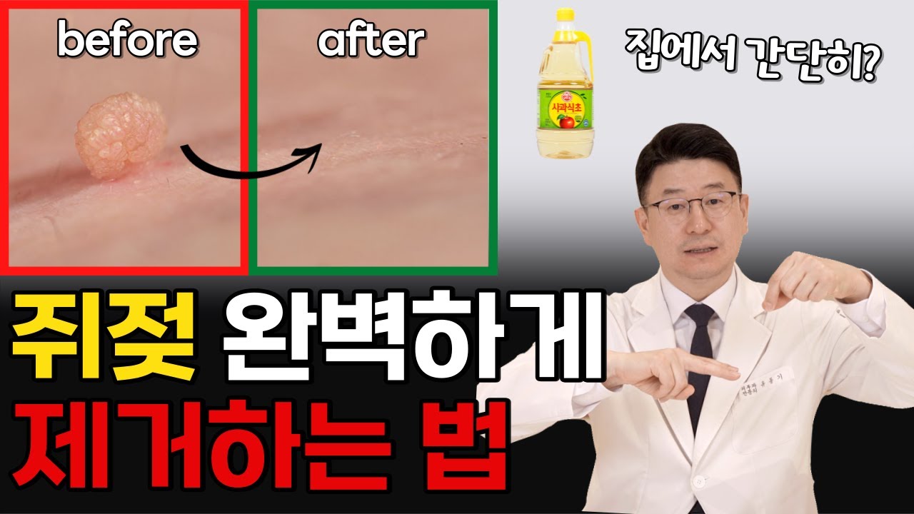 이것 뿌리면 쥐젖 제거 가능? 피부과 전문의가 알려주는 쥐젖, 편평사마귀 없애는 방법 - YouTube
