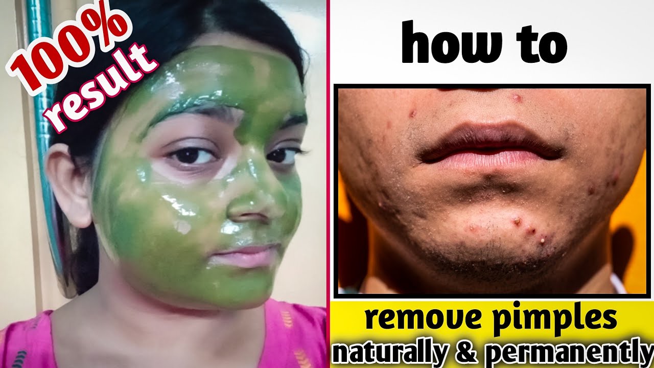 How To Remove Pimples Naturally