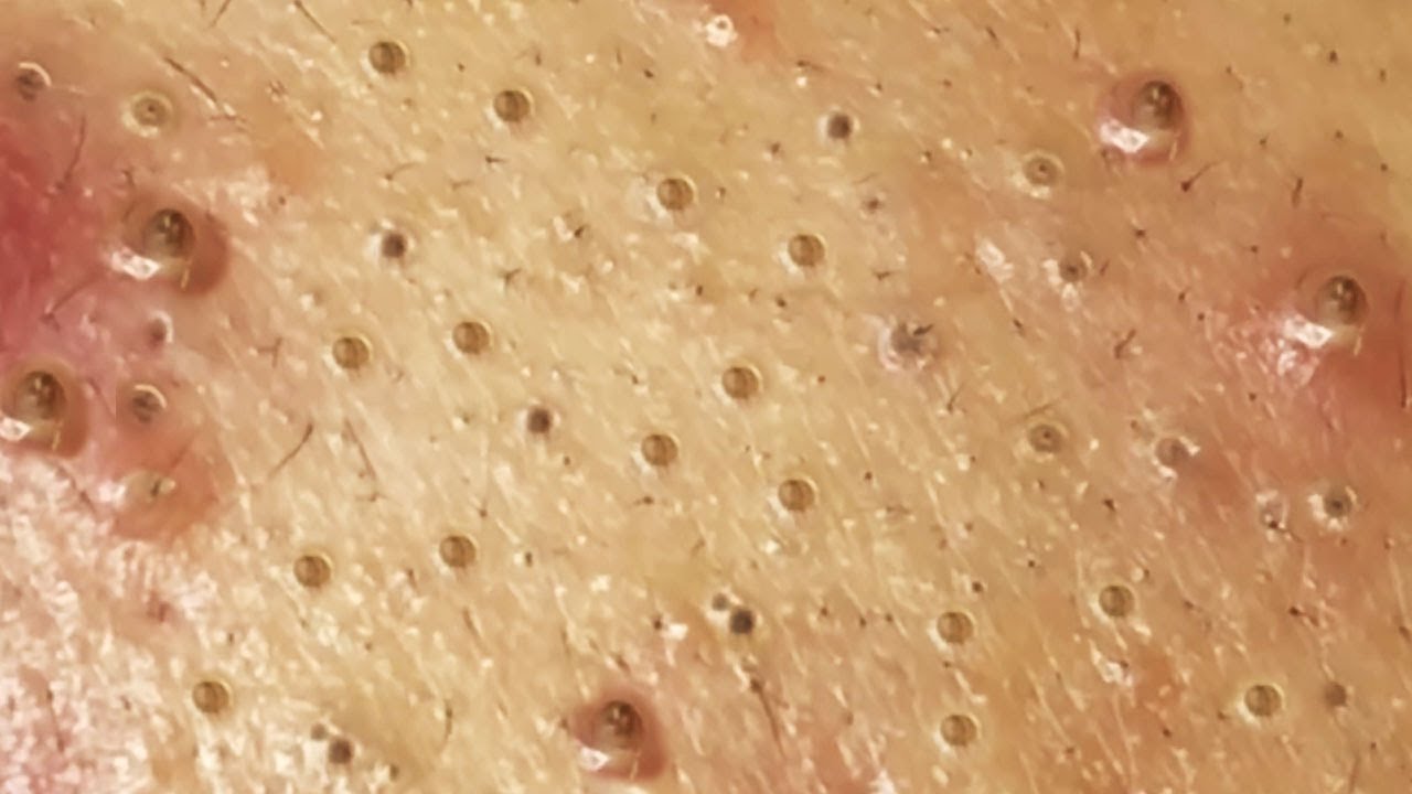 Blackhead removal Video #75 #Blackheads #blackheadsremoval #sebum - YouTube