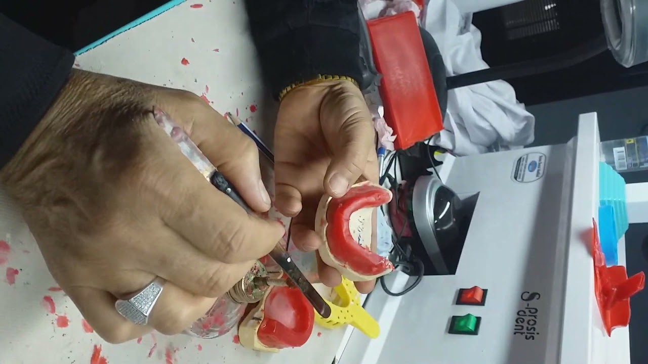 fabrication of mandibular occlusion rim (bite rim) للفك السفلي . - YouTube