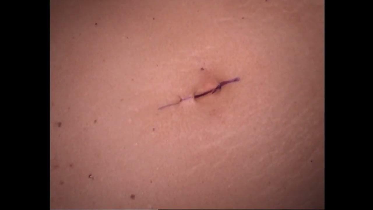 Open (Hasson) technique for laparoscopic entry - YouTube