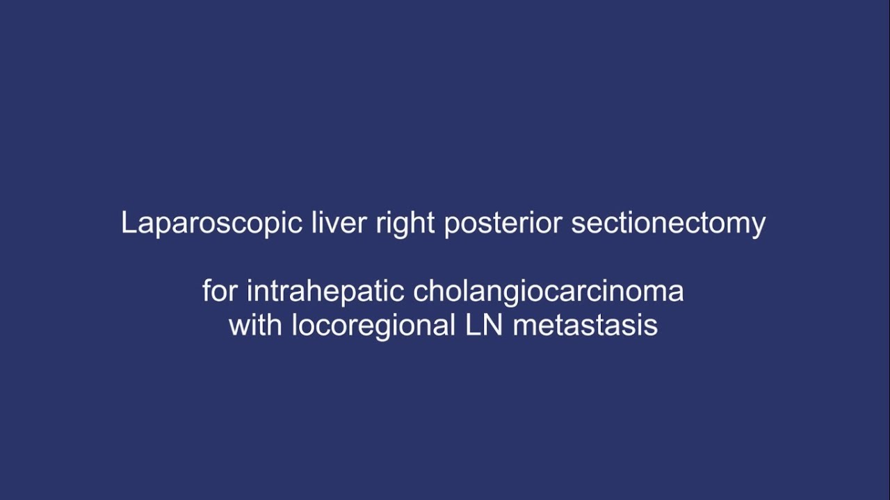 Laparoscopic liver right posterior sectionectomy and LN Dissection ...
