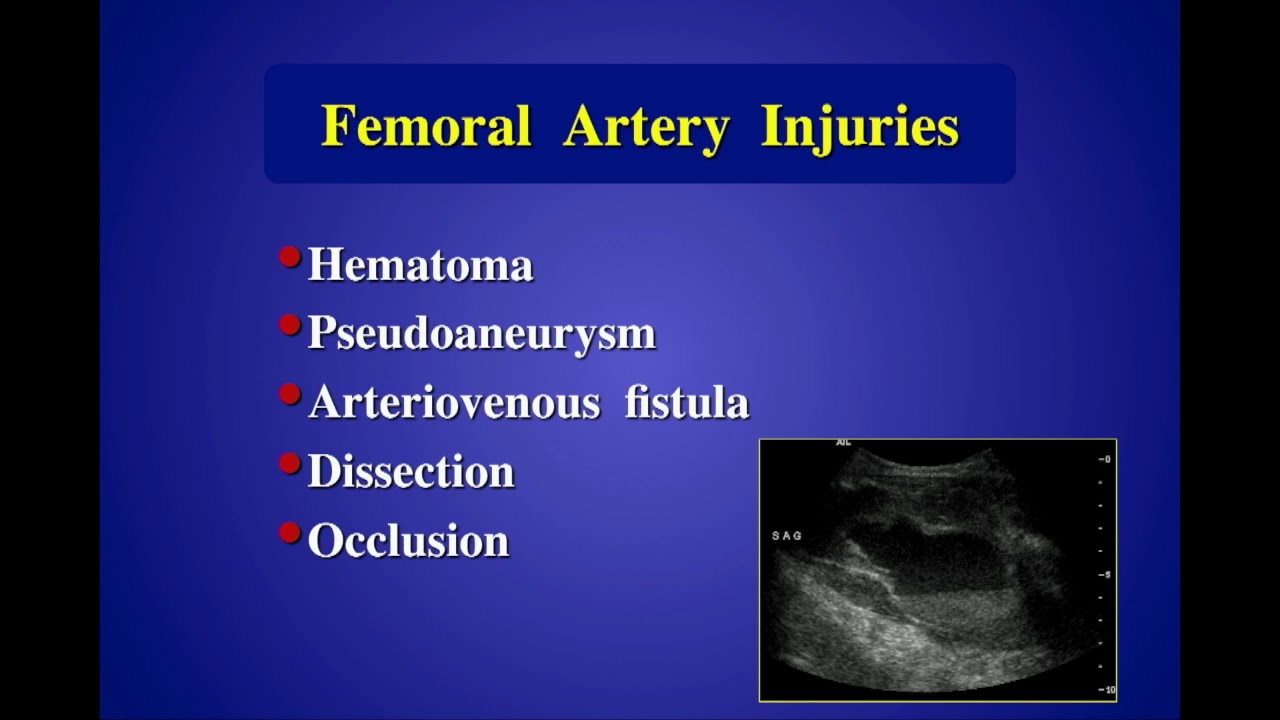 Pseudoaneurysm Av Fistula