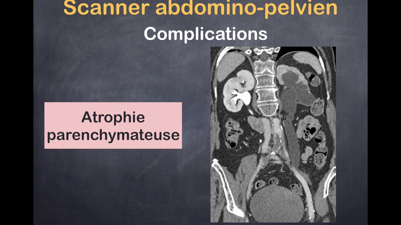 Lithiase Urinaire - 4. Complications - YouTube