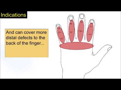 Intermetacarpal Flap - YouTube