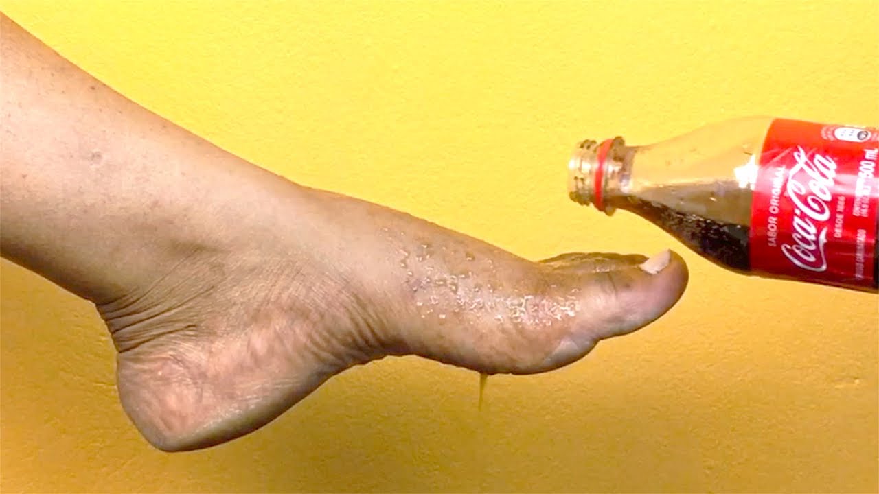 🌟 Cosmetologist Reveals The Secret! Pour Coca-Cola on your feet and ...