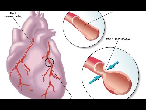 Prinzmetal angina (Coronary Vasospasm) - YouTube