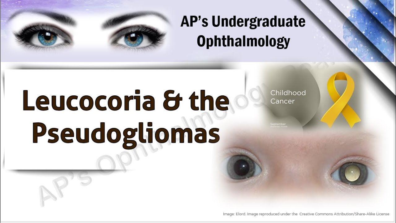 Leucocoria & the Pseudogliomas | AP'S Undergraduate Ophthalmology - YouTube
