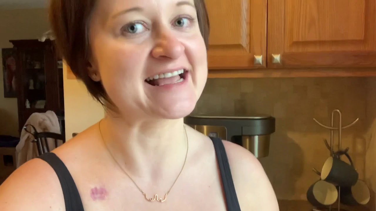 Port Scar Laser Treatment - YouTube